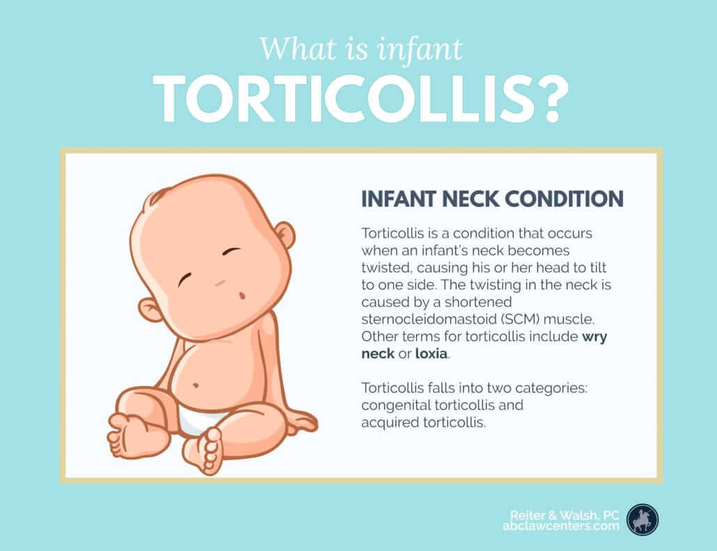 What is Torticollis: Causes, Signs, and How Early Treatment Helps ...